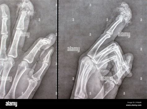 Plain X Ray Reveals Distal Tip Amputation Of Distal Phalanx Of The