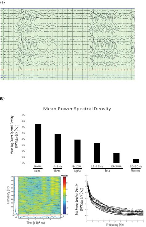 Electroencephalogram Analysis Of The Cask R27 Mutation Patient A