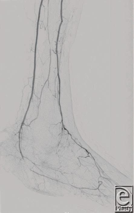 Right Lower Extremity Angiography Following Angioplasty Of The