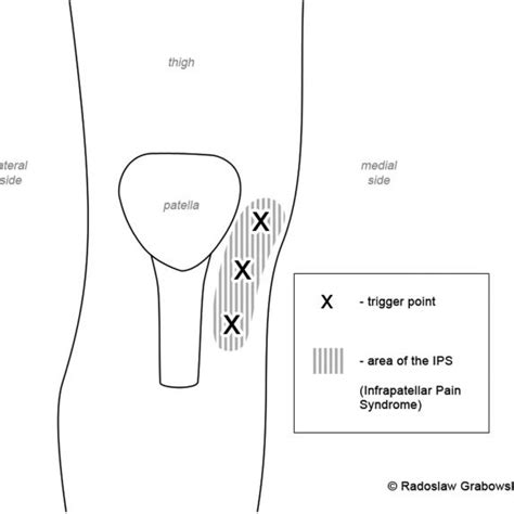 Infrapatellar Branch Of Saphenous Nerve After Excision Of The Neuroma