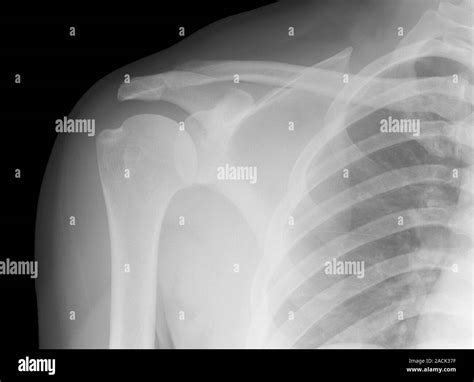 X Ray Normal Shoulder Normal Shoulder X Ray 3 Shower Curtain By