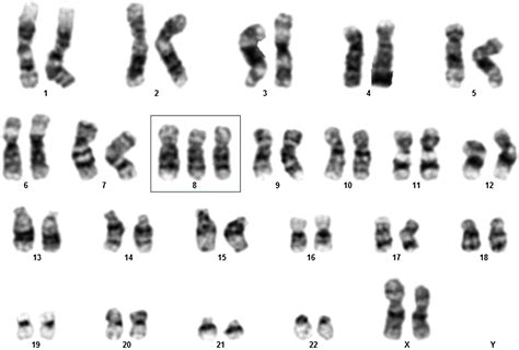 Pyoderma Gangrenosum Diagnosed In A High Risk Myelodysplastic Neoplasm