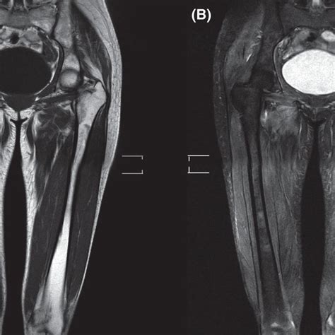 Magnetic Resonance Imaging Mri Of Hip And Thighs Showing Diffuse