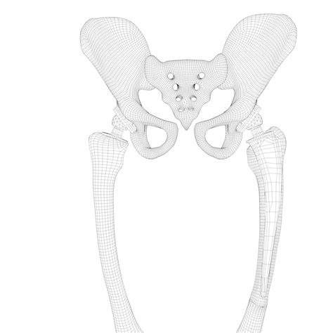 Hip Replacement Implant Installed In The Pelvis Bone 3d Model