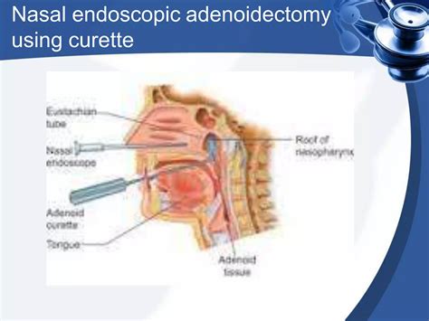 Adenoidectomy Pptx
