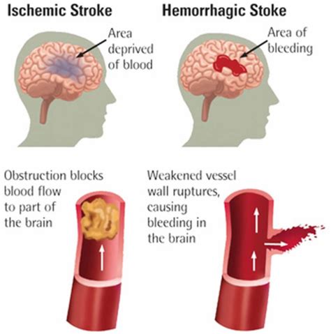 CVA Flashcards Quizlet
