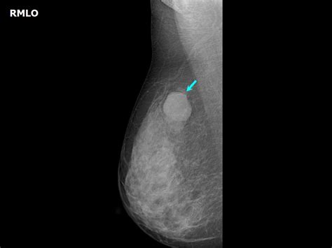 Atlas Of Breast Cancer Early Detection
