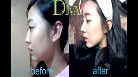 디바성형외과 리얼스토리 예원편 Youtube