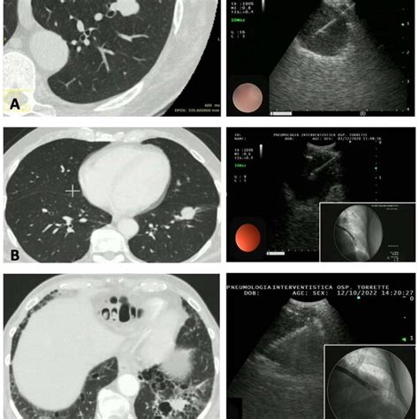 Three Cases Of Peripheral Pulmonary Nodules Of The Left Lung Approached Download Scientific