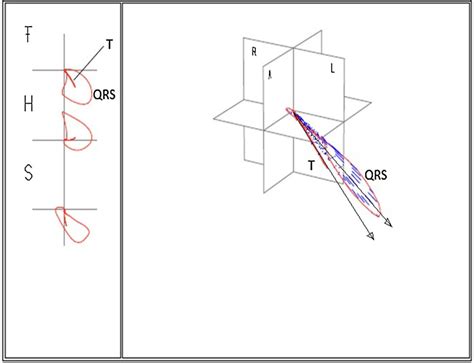 Projections Of Qrs And T Wave Loops On Frontal F Horizontal H And