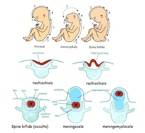 Neural Tube Defects Paxawu91