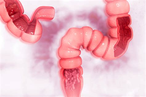결 장 암입니다 암 공격 셀입니다 콜론 질병 개념 대장내시경에 대한 스톡 사진 및 기타 이미지 대장내시경 3차원 형태
