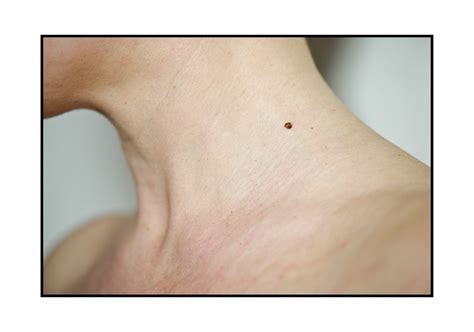 Lucky And Unlucky Moles On Female Male Body Parts ~ Indian Palmistry