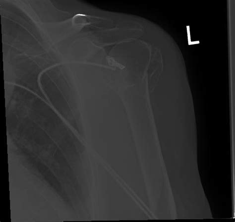 Bone Fracture Detection Object Detection Dataset V4 V4 By Veda