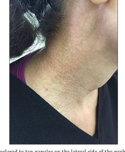 Figure 1 From A Case Series Of Pseudoxanthoma Elasticum Like Disorders Semantic Scholar