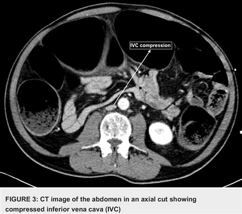 Figure 3 From Abdominal Compartment Syndrome Secondary To Constipation