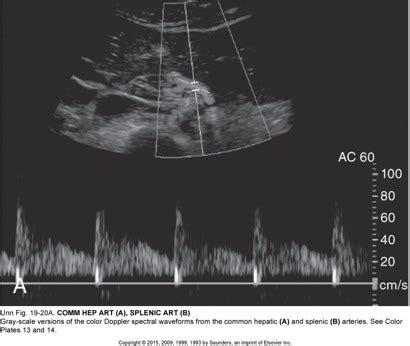 DMS Abdominal Doppler Flashcards Quizlet