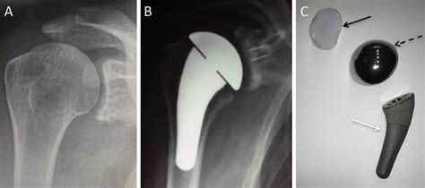 A Radiography Of Centered Osteoarthritis Oa B Radiography Of