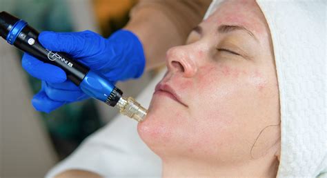 Innopen And Crl Medical Needling Tools