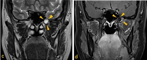 Mri Features Of Arrested Pneumatization Of Sphenoid Sinus A T1