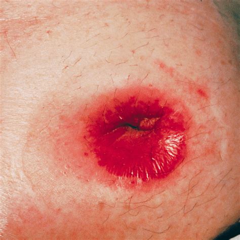 Stoma Prolapse Stenosis And Retraction Ostomy Canada Society