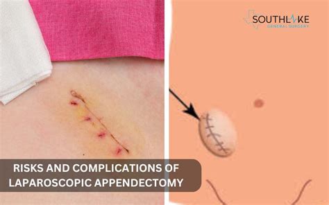 Laparoscopic Appendectomy A Comprehensive Overview Southlake General Surgery