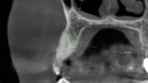 Immediate Maxillary Premolar Implant Case Presentation With Steve