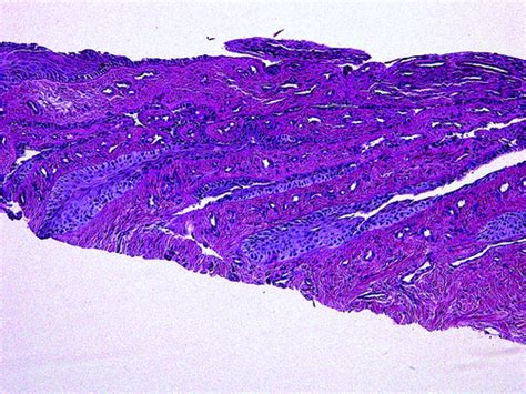 Acantholytic Acanthoma