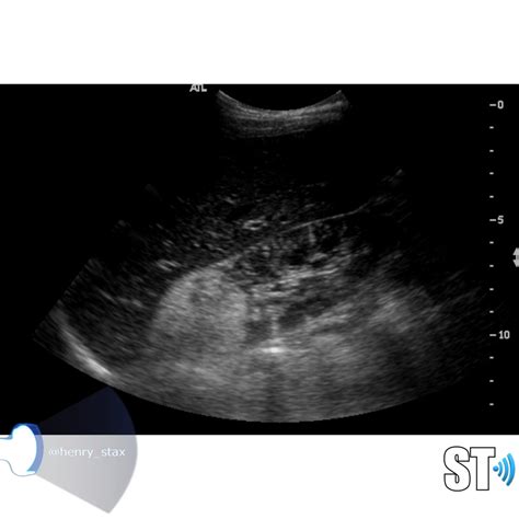 Renal Pathology Artofit