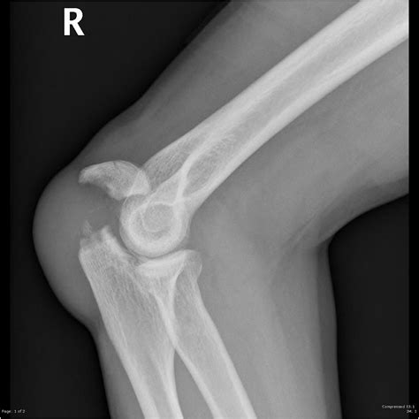 Olecranon Avulsion Fracture Medical Knowledge Avulsion Fracture