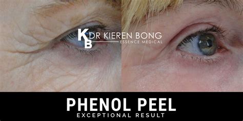Phenol Chemical Skin Deep Peel Glasgow