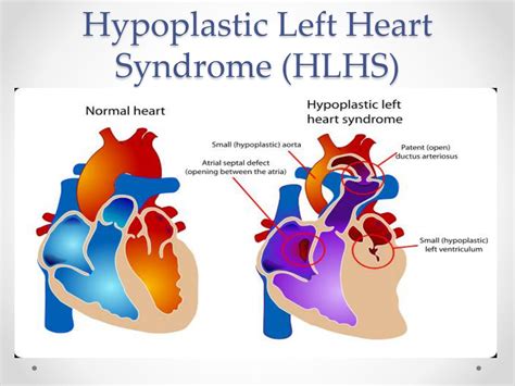 Ppt Congenital Heart Disease Powerpoint Presentation Free Download