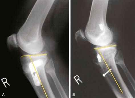 Tibial And Femoral Osteotomy For Varus And Valgus Knee Syndromes