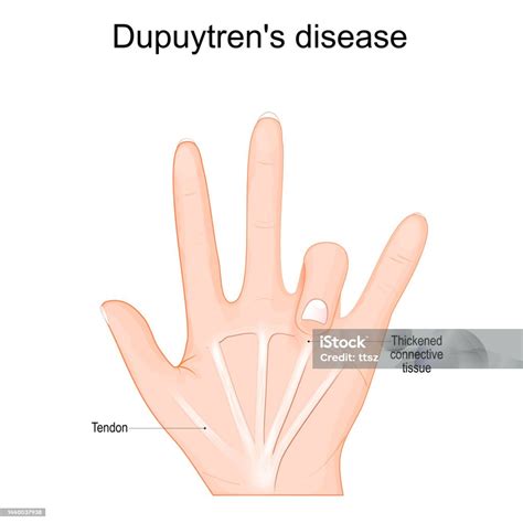 Dupuytrens Disease Human Hand With Tendons Stock Illustration