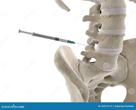 A Lumbar Spine Injection Stock Illustration Illustration Of Artwork