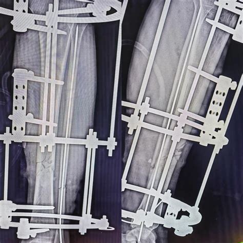 告別大疤痕拒絕骨感染骨折四大微創固定技術之外固定架固定術 每日頭條