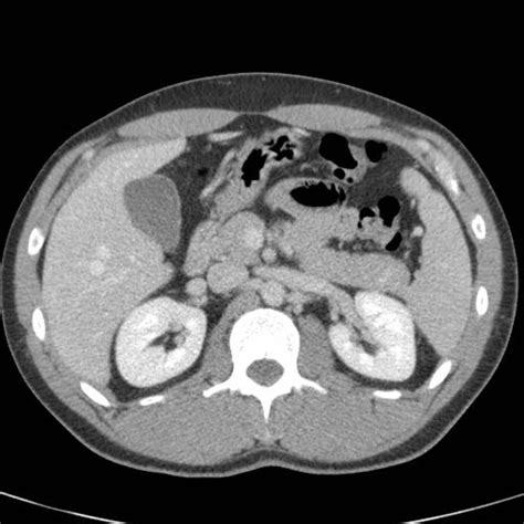 Retroscapular Lipoma On Radiologist Headquarters Facebook