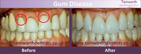 Gum Disease Before And After 1 India New England News