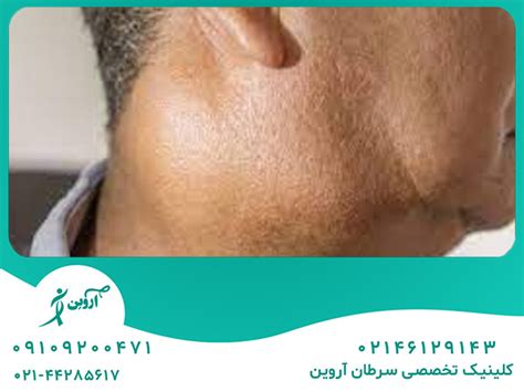 سرطان غدد لنفاوی چیست و سرطان غدد لنفاوی چگونه درمان میشود