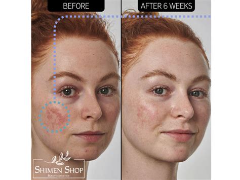 سرم آزلاییک اسید 10درصد رفع کننده قرمزی پوست و جای جوش اینکی لیست 30