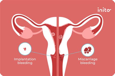 Implantation Bleeding Vs Miscarriage Know The Difference