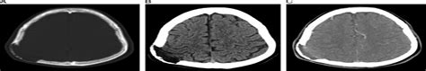 Benign Meningioma With Rare Radiological And Behavioral Feat