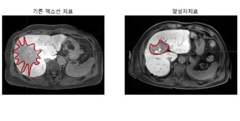 Medigate News 양성자치료 간암 치료에 효과적