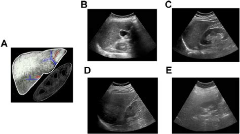 Ultrasound Images Of Fatty Liver