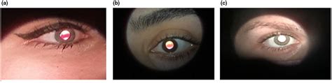 Retinoscopy In Keratoconus At June Blackwell Blog