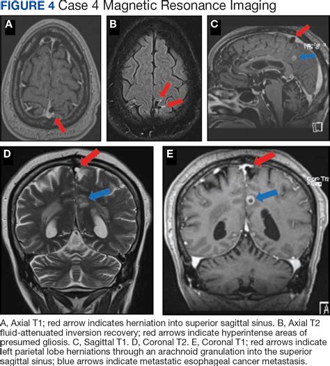 Uncommon Locations For Brain Herniations Into Arachnoid Granulations 5 Cases And Literature