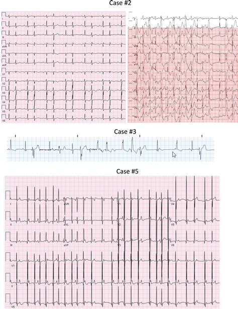 Multifocal Ectopic Premature Purkinje Related Complexes Syndrome In