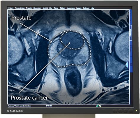 Multiparametric MRI Of The Prostate ALTA Klinik