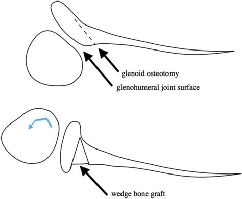 Combined Glenoid Anteversion Osteotomy And Tendon Transfers For