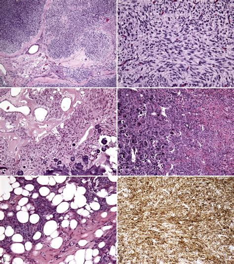 Sex Cord Stromal And Miscellaneous Tumors Of The Ovary Obgyn Key